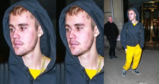 Justin Bieber spotted looking downcast with a severe case of acne ... Justin Bieber spotted looking downcast with a severe case of acne ...