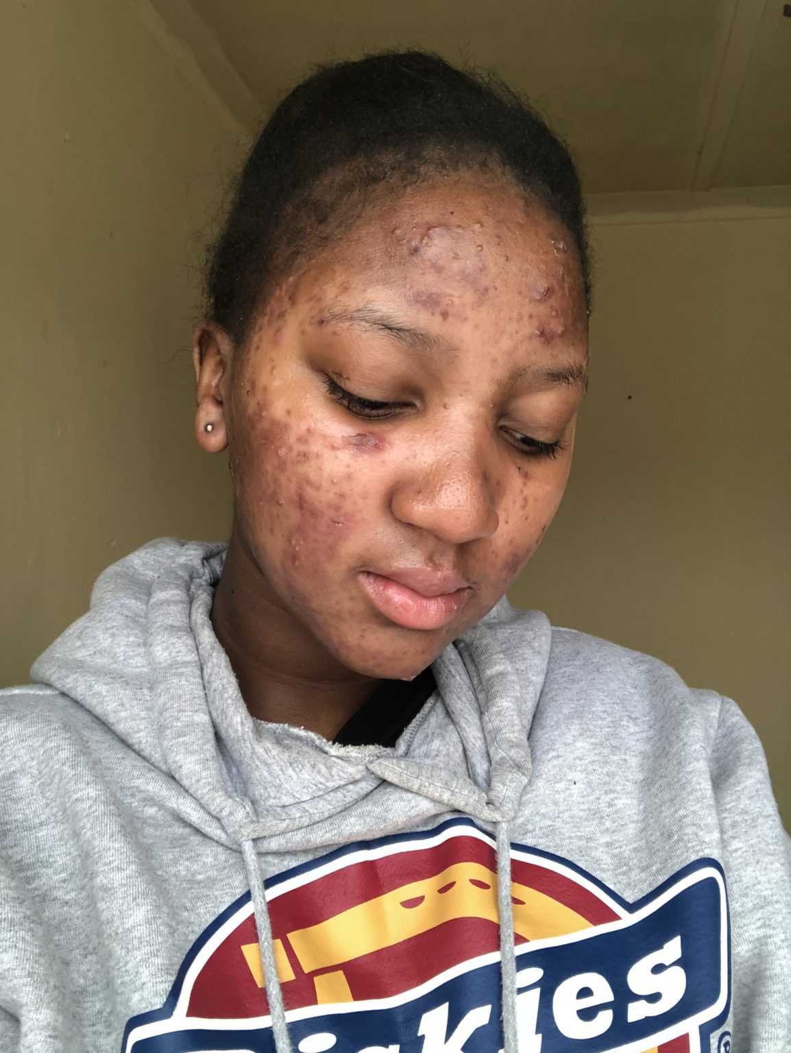 Lady diagnosed with acne shocks many after sharing photos of her facial ...