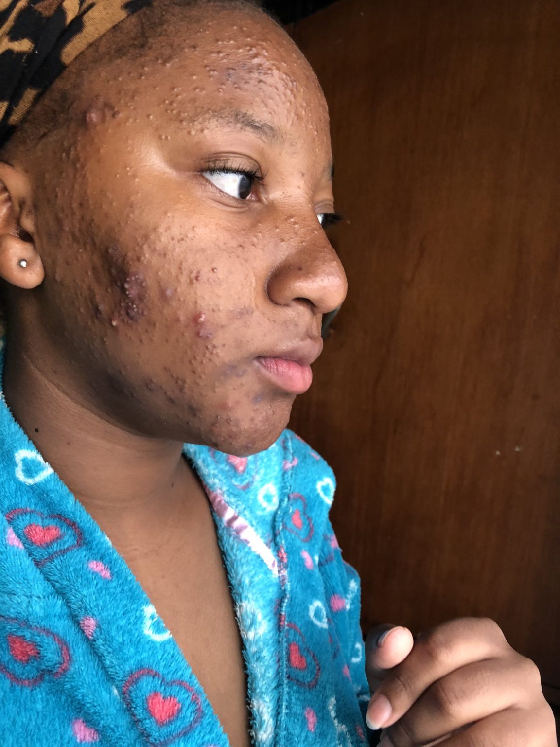 Lady diagnosed with acne shocks many after sharing photos of her facial ...
