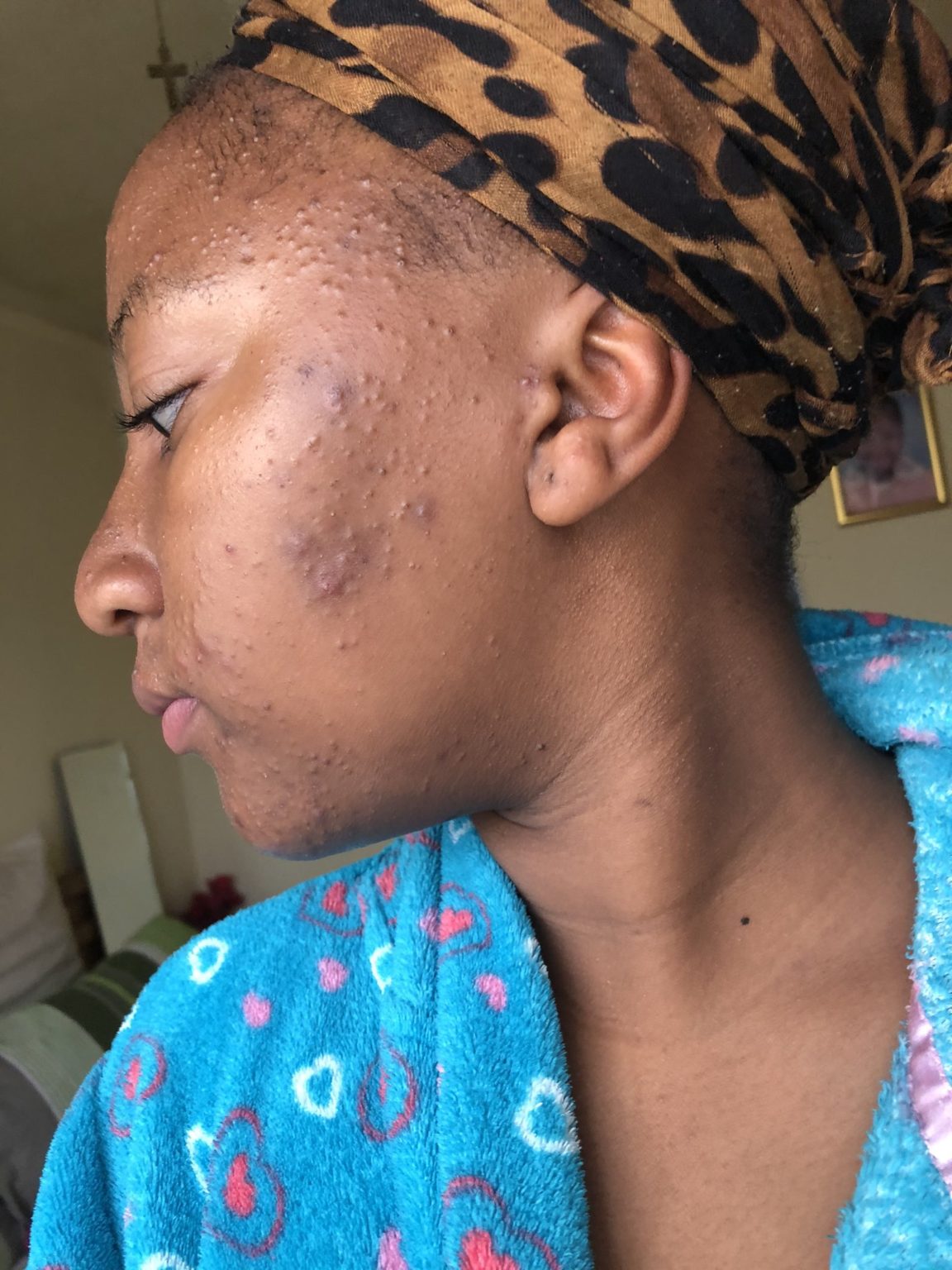 Lady diagnosed with acne shocks many after sharing photos of her facial ...
