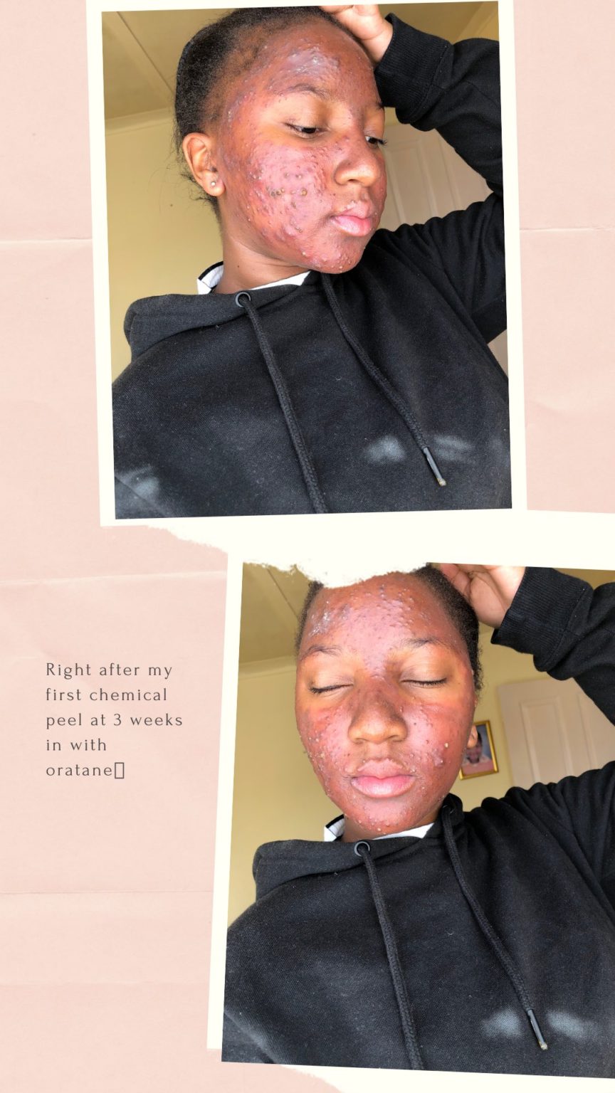 Lady diagnosed with acne shocks many after sharing photos of her facial ...