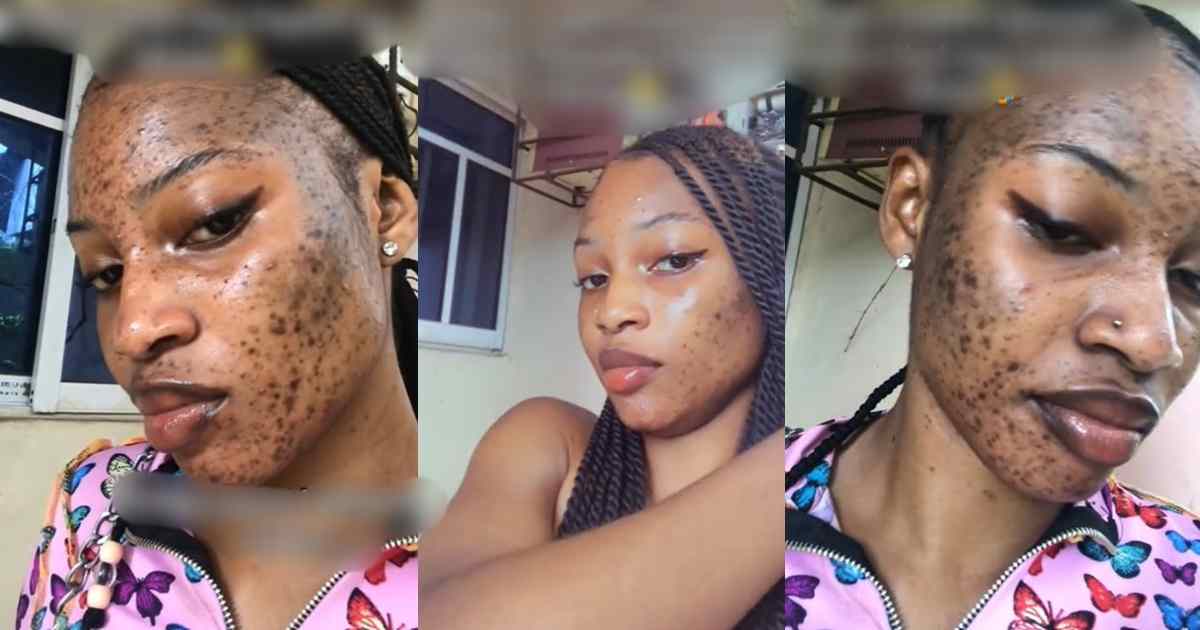 Lady develop facial rash after using skincare product heavily promoted ...